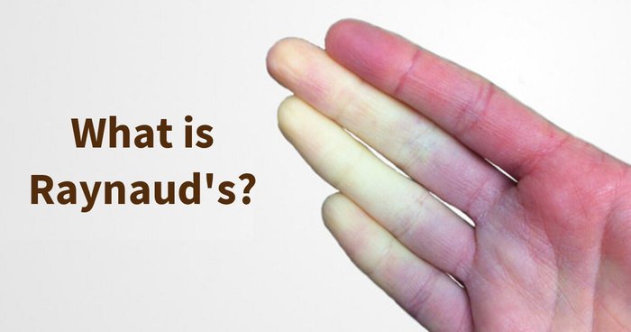 Τι είναι το "Raynaud" ? :: Σπύρος Νίκας Ρευματολόγος