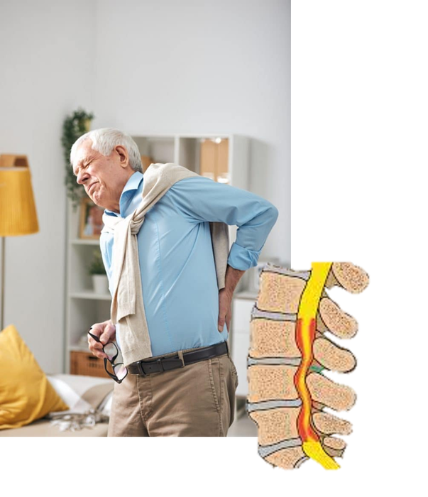 Τι είναι η σπονδυλική στένωση (Spinal Stenosis) :: Σπύρος Νίκας ...